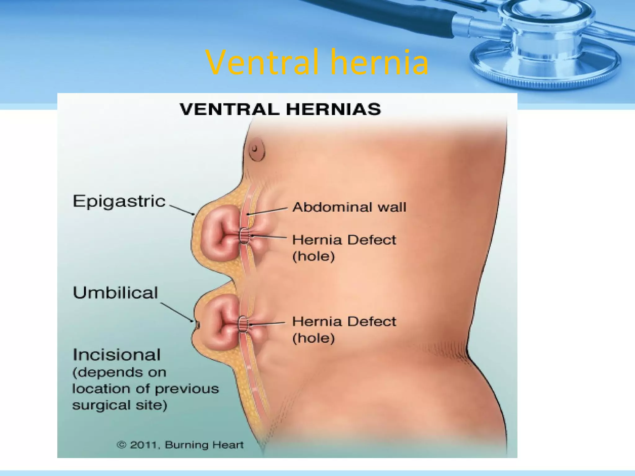 Ventral hernia by Dr Teo | PPT