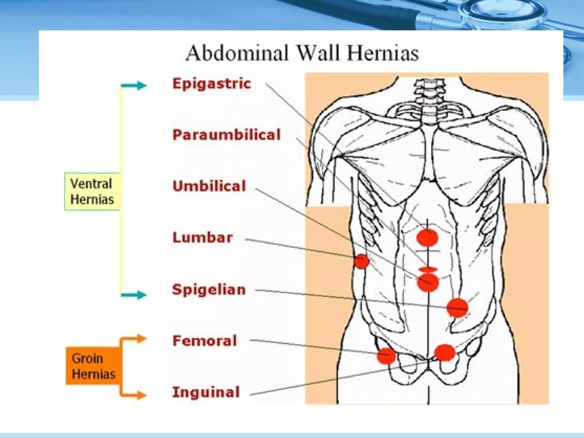Ventral hernia by Dr Teo | PPT