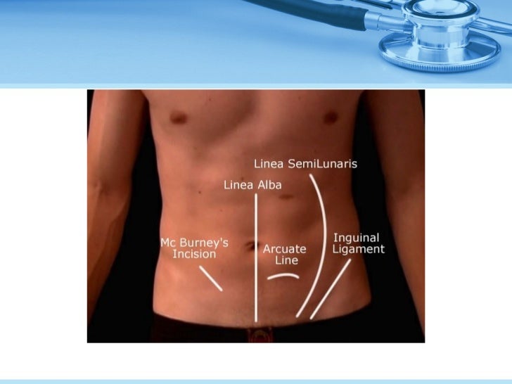 Ventral hernia by Dr Teo