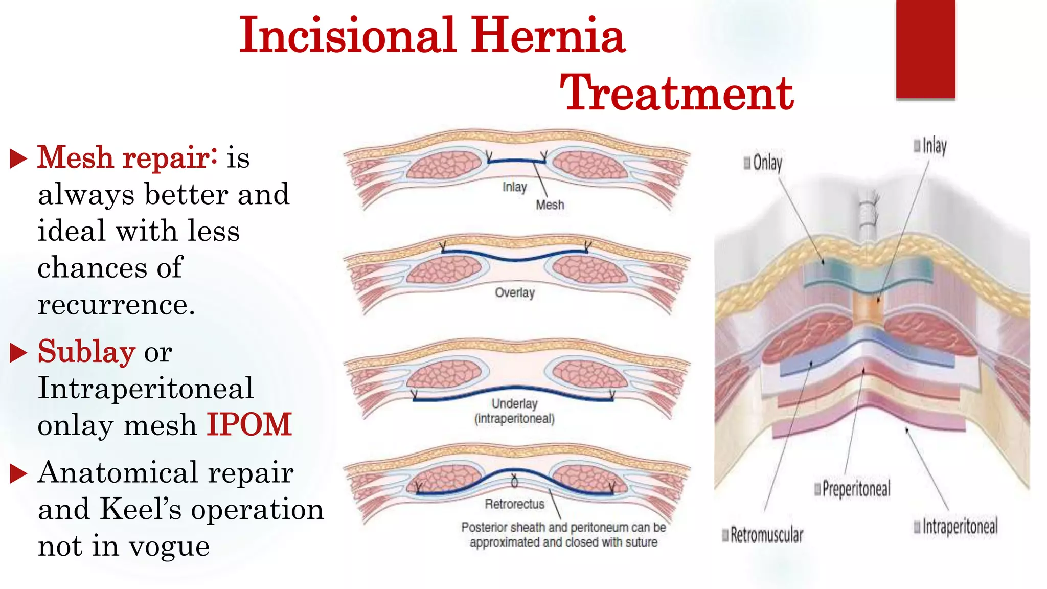 VENTRAL HERNIA | PPTX