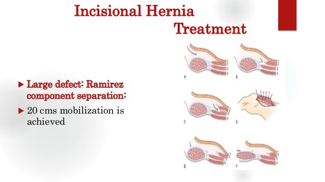 VENTRAL HERNIA