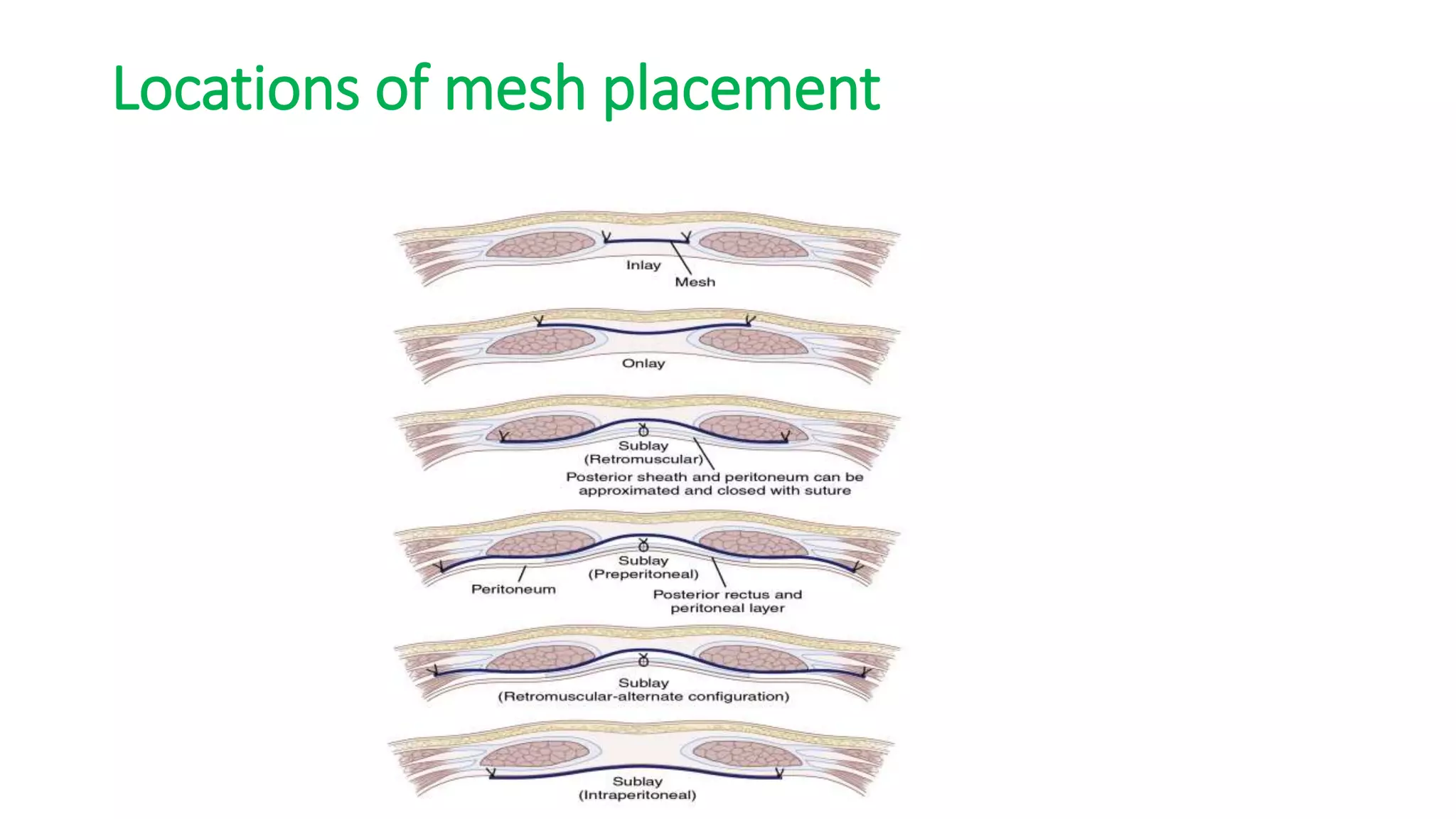 Ventral hernia | PPTX