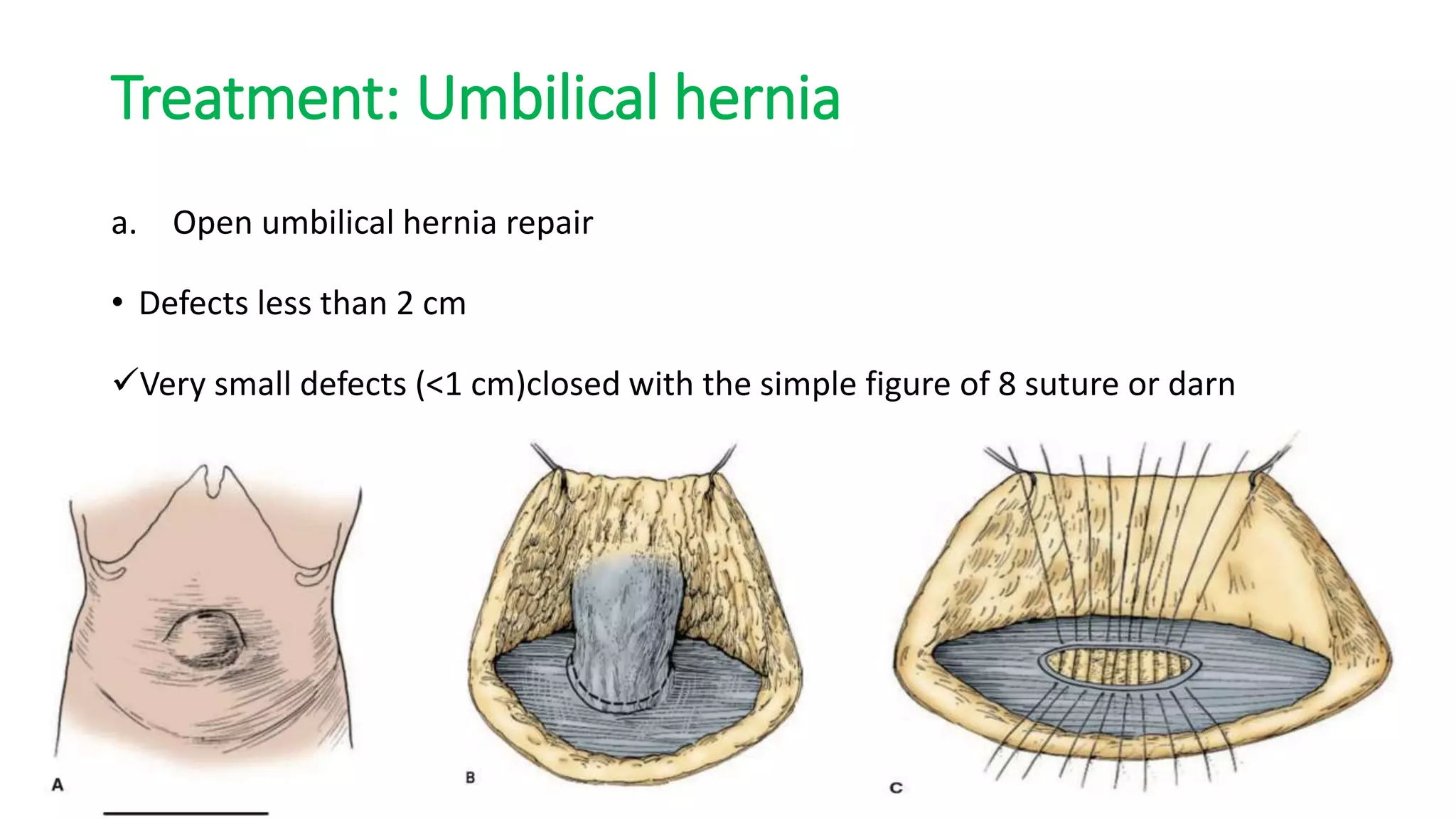 Ventral hernia | PPTX