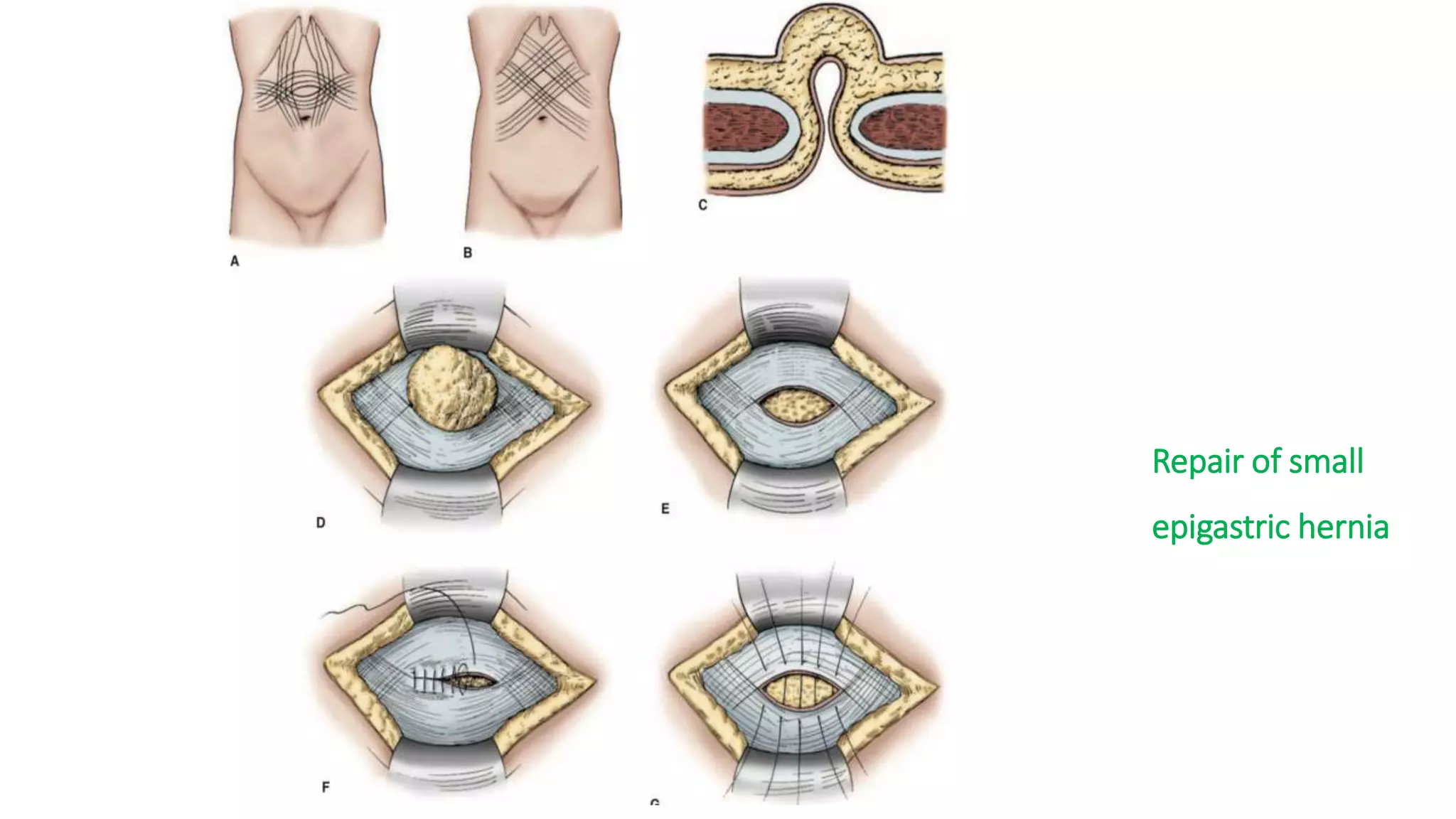 Ventral hernia | PPTX