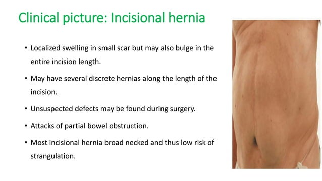 Ventral hernia | PPTX