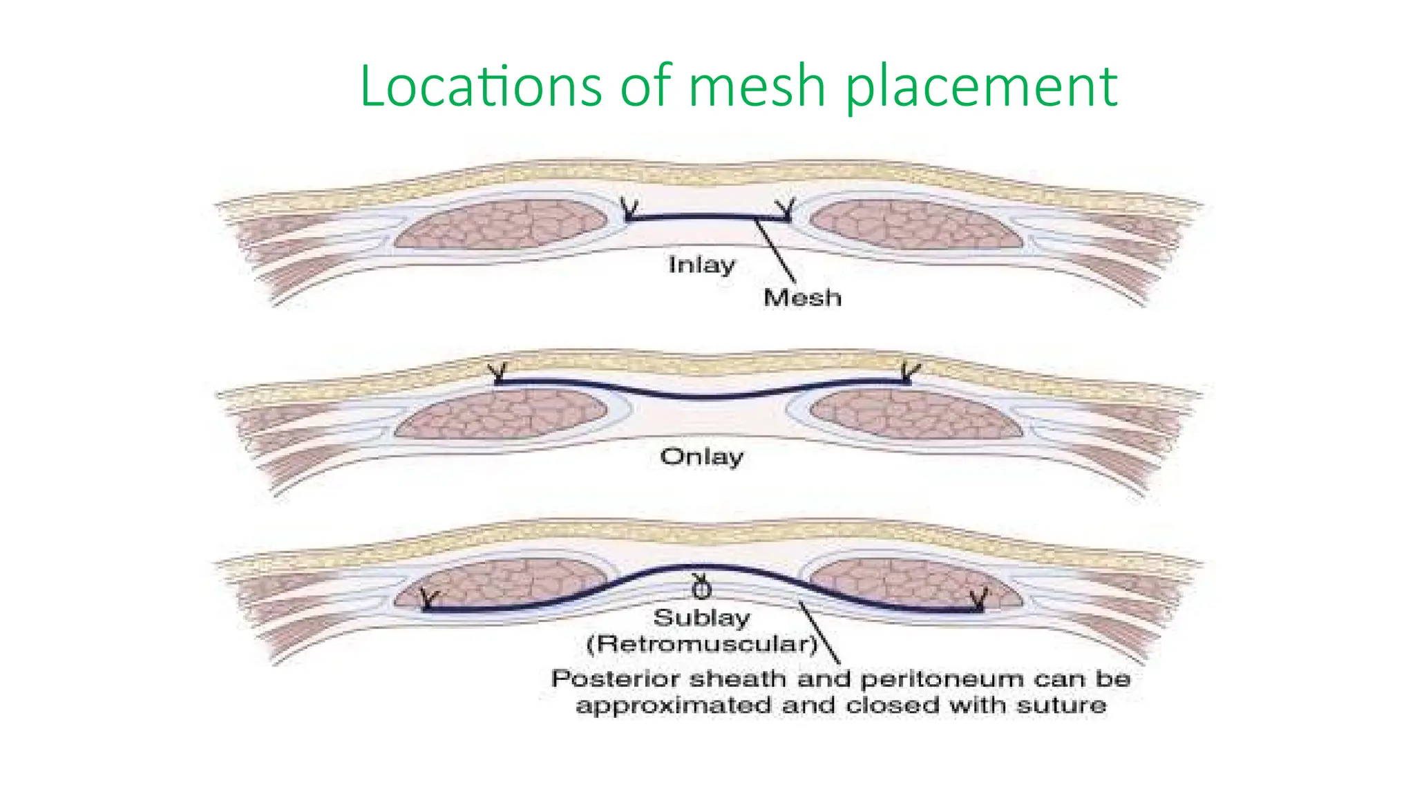 VENTRAL HERNIA - Abdominal Wall Reconstruction AWR - Surgery -Repair - Incisional Hernia | PPT