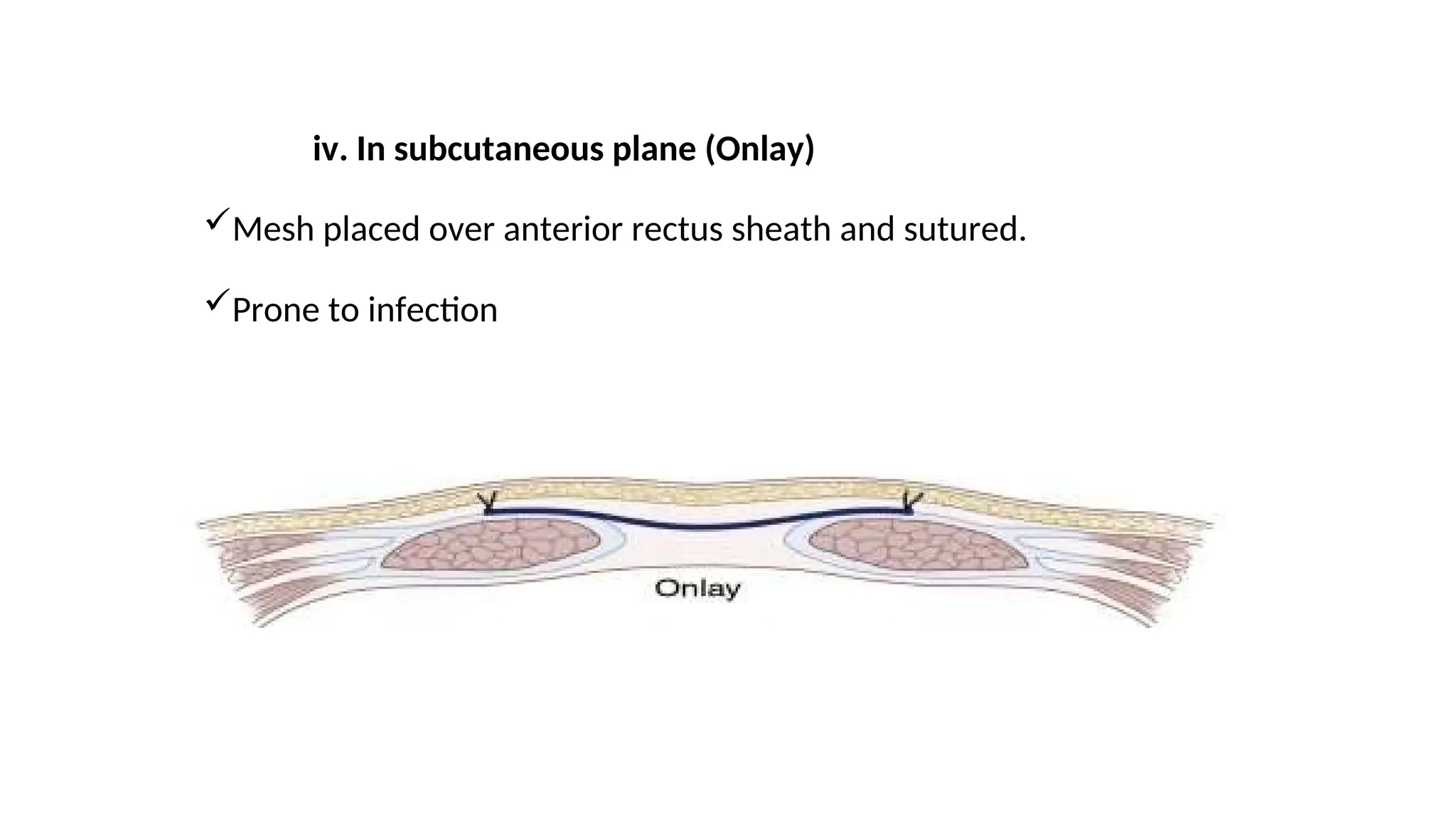 VENTRAL HERNIA - Abdominal Wall Reconstruction AWR - Surgery -Repair ...