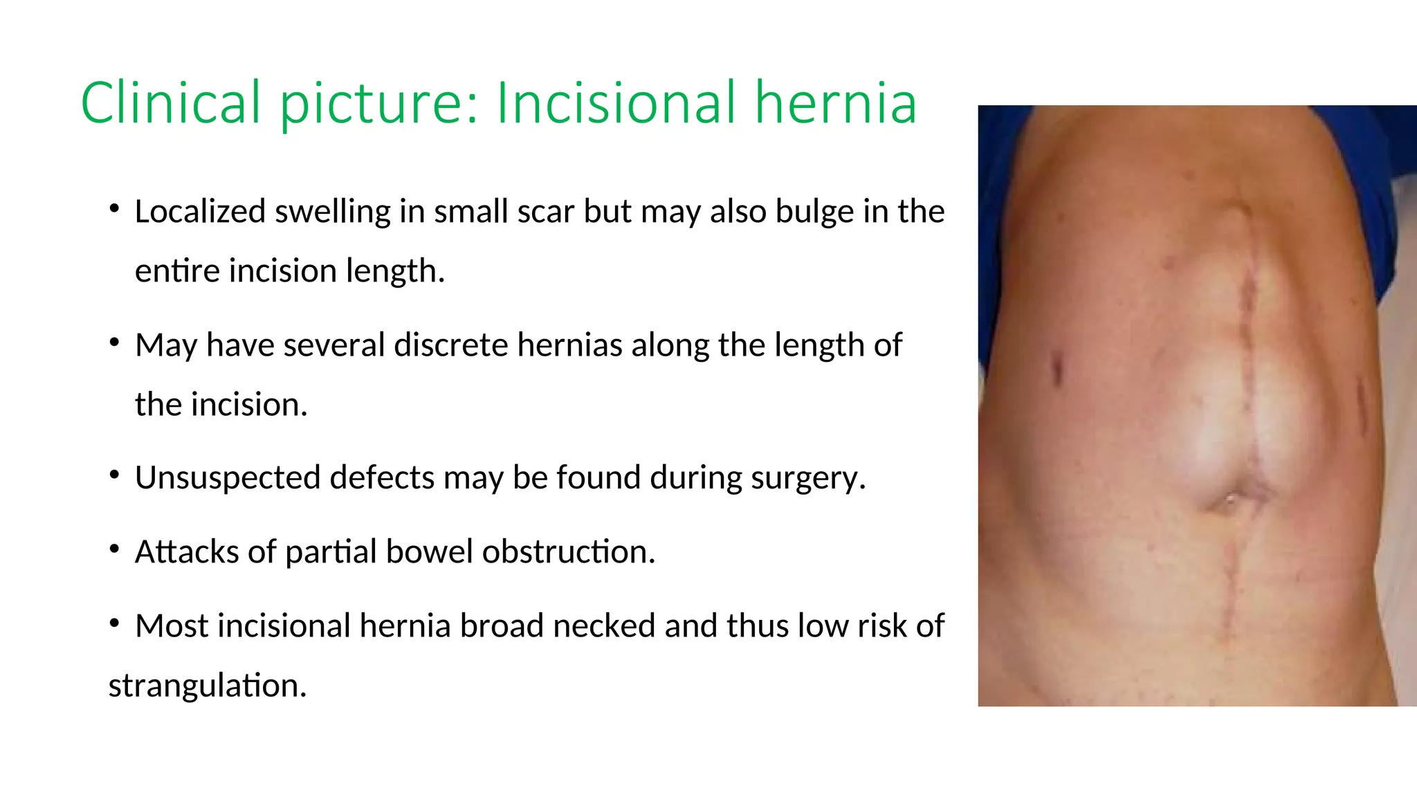 VENTRAL HERNIA - Abdominal Wall Reconstruction AWR - Surgery -Repair - Incisional Hernia | PPT