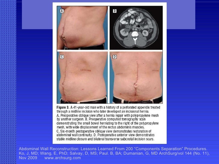 Ventral Hernia: Challenges and Choices