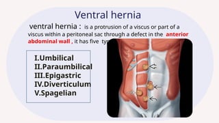 VENTRAL HERNIA GROUP 1 SECTION SURGERY.pptx