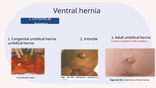 VENTRAL HERNIA GROUP 1 SECTION SURGERY.pptx