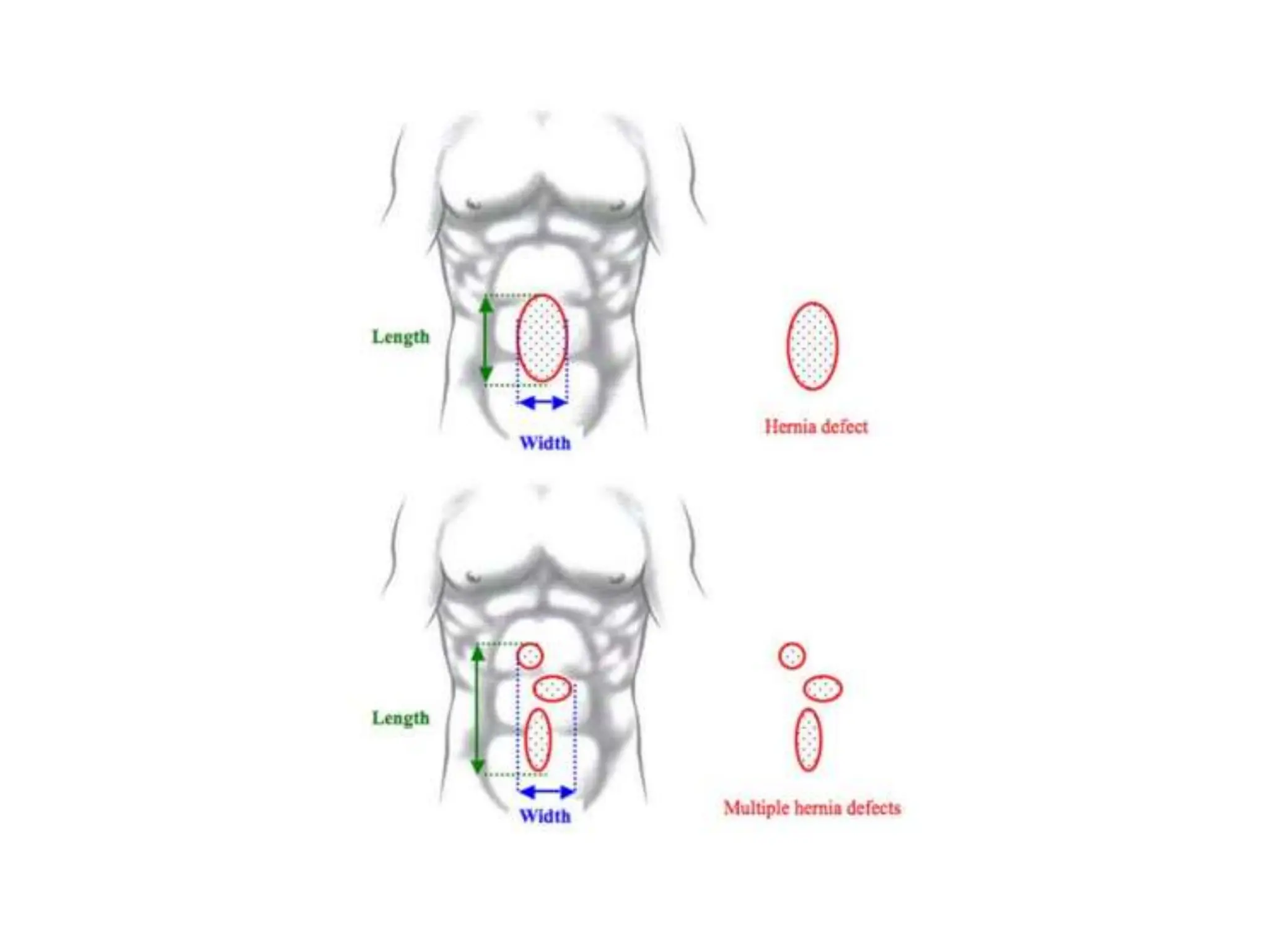 Ventral Hernia Inguinal Hernia Anterior Abdominal Wall Pptx 3296