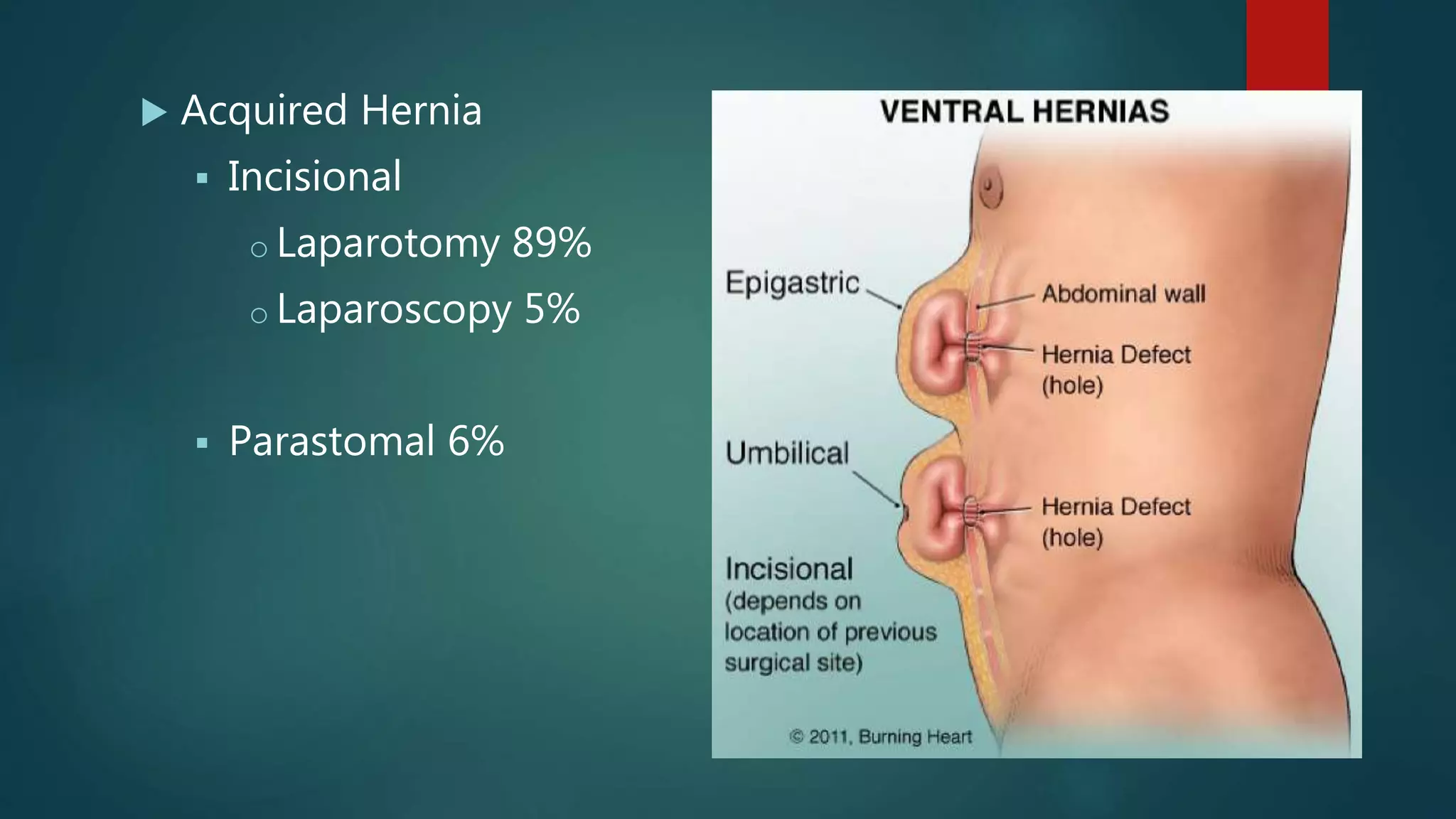 Ventral hernia management | PPTX