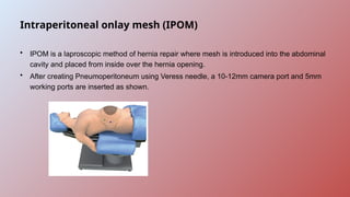 ventral hernia repair-DEPARTMENT OF GENERAL SURGERY | PPTX