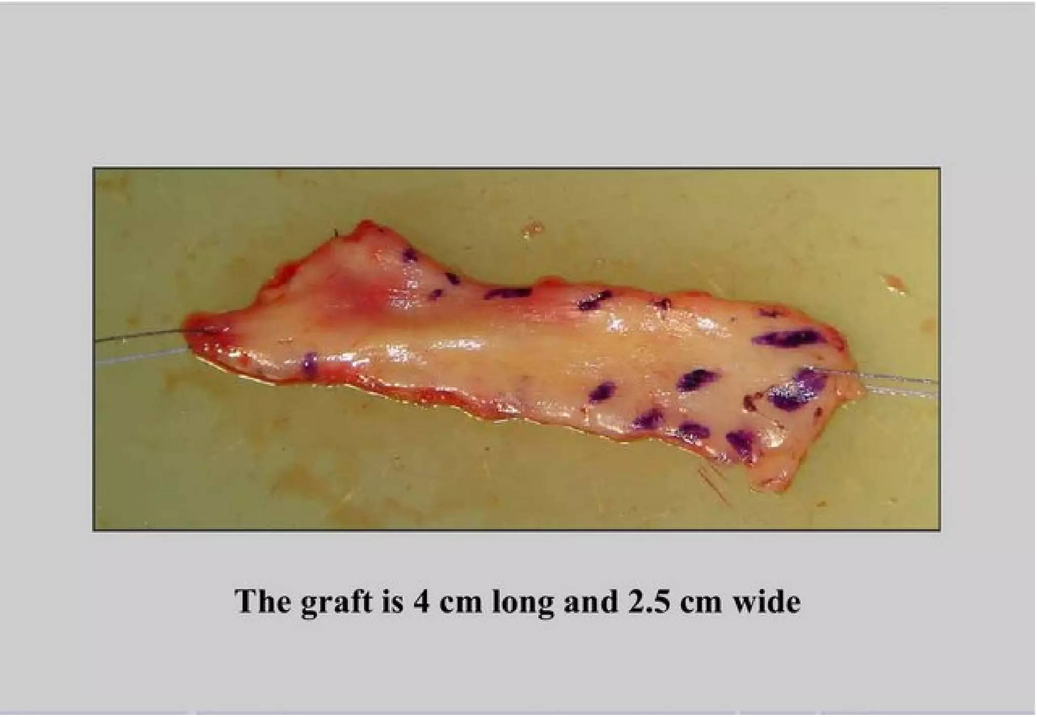 Ventral oral mucosal onlay graft urethroplasty | PDF