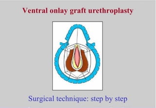 Ventral oral mucosal onlay graft urethroplasty | PPT