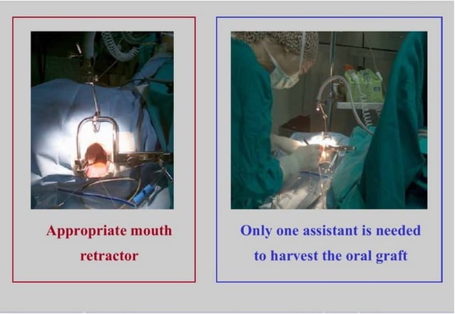 Ventral oral mucosal onlay graft urethroplasty | PDF