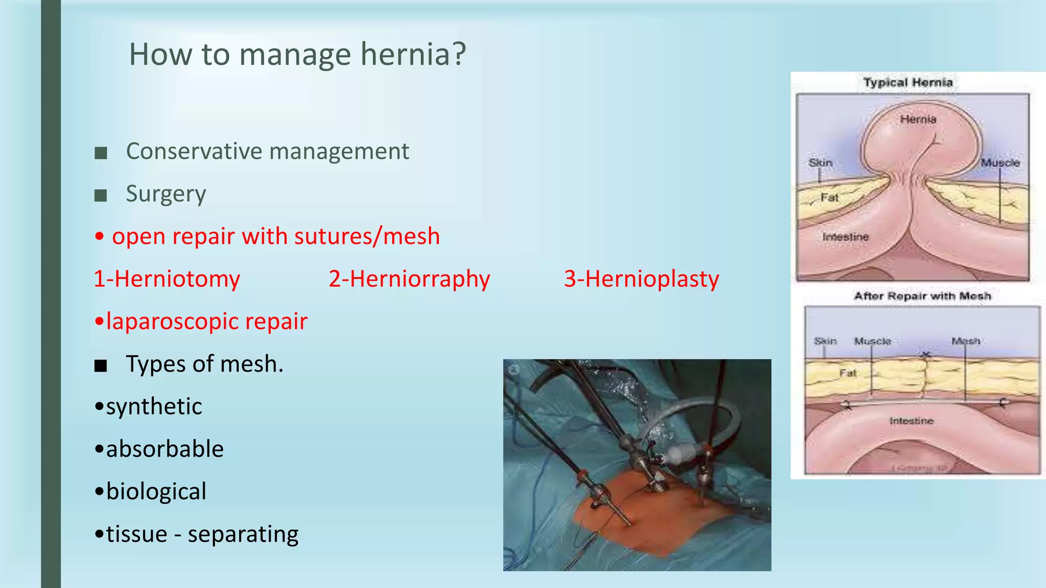 VENTRAL WALL HERNIA.pptx