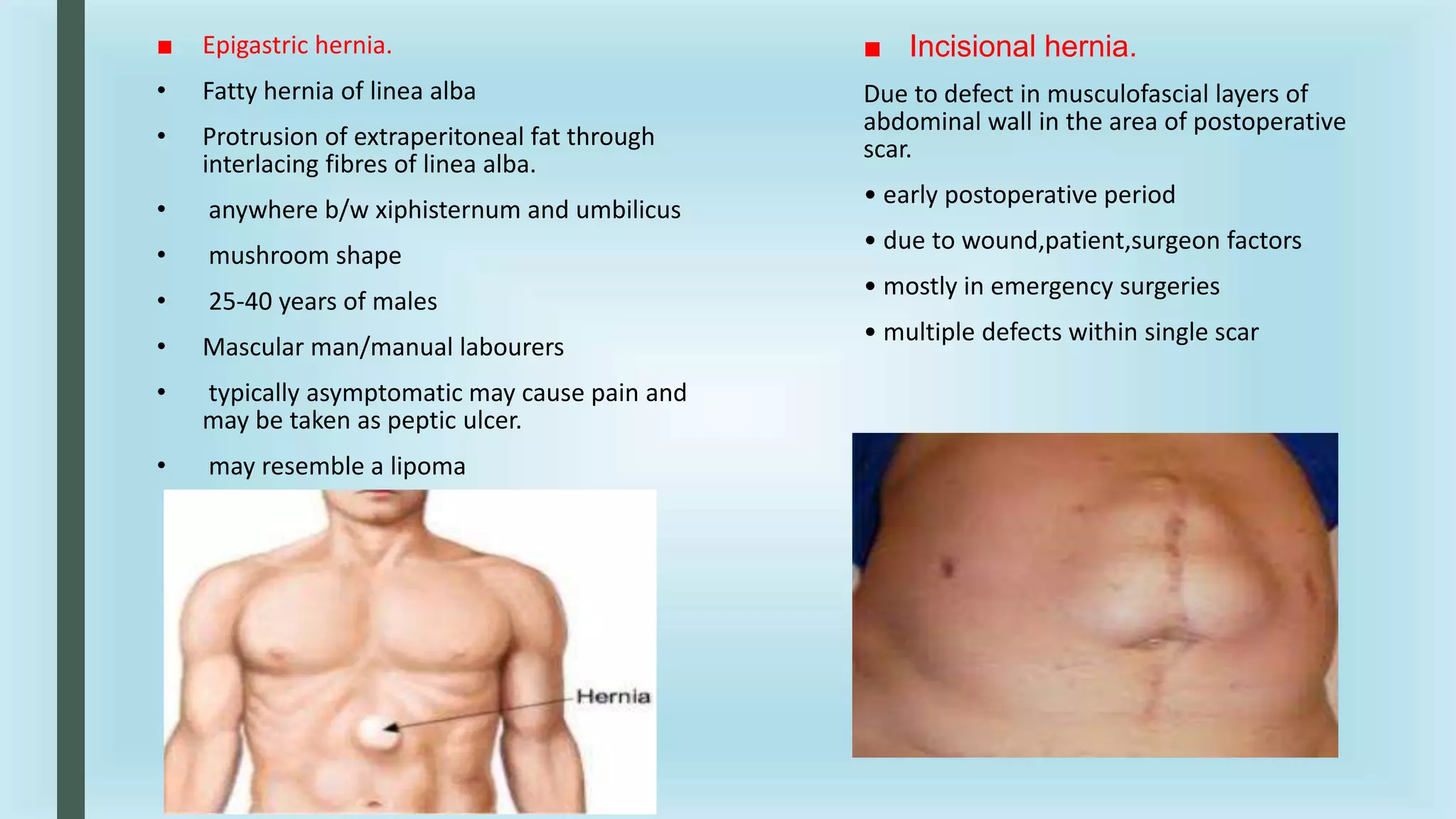 VENTRAL WALL HERNIA.pptx