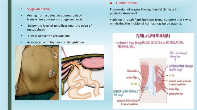 VENTRAL WALL HERNIA.pptx
