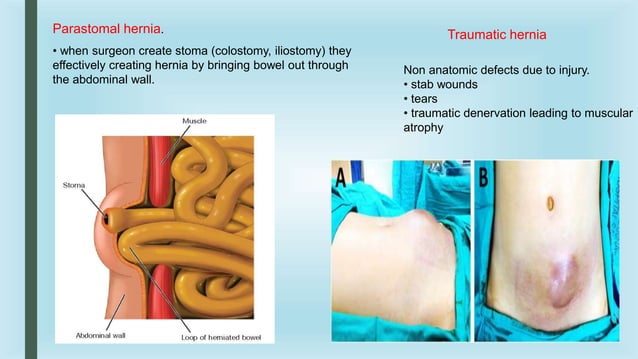 VENTRAL WALL HERNIA.pptx