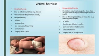 VENTRAL WALL HERNIA.pptx