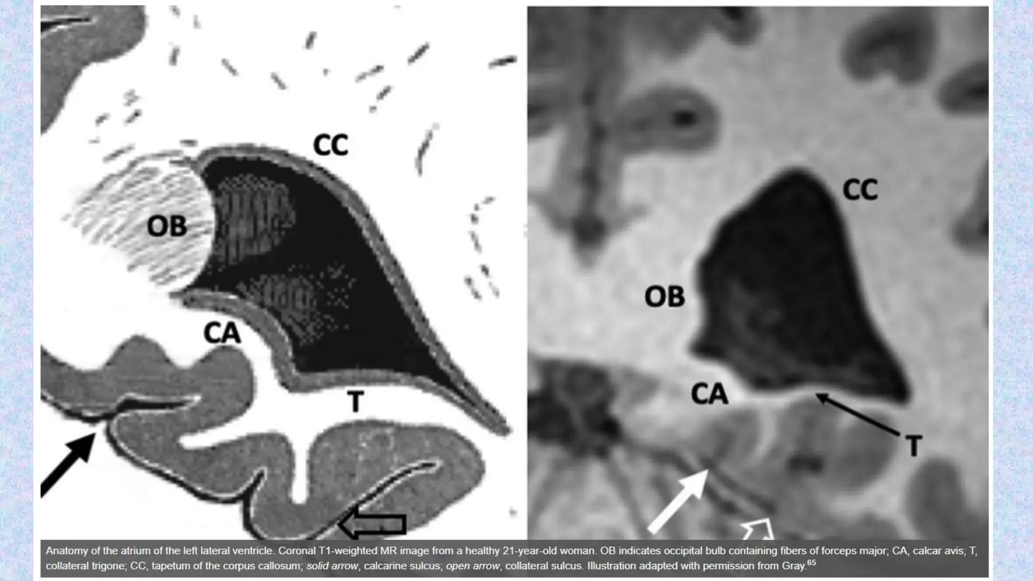 VENTRICLES AND CISTERNS OF HUMAN BRAIN.pptx