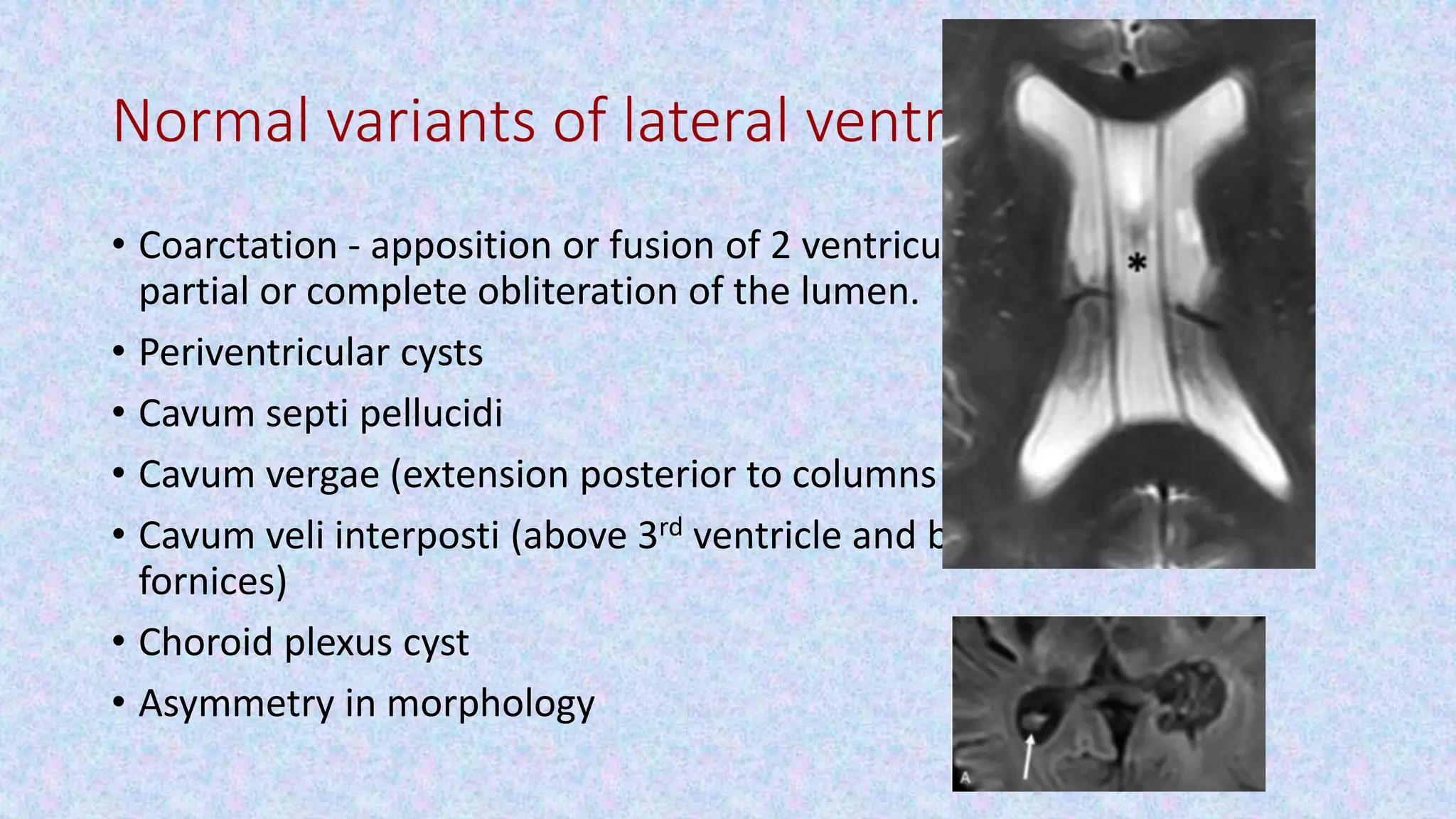 VENTRICLES AND CISTERNS OF HUMAN BRAIN.pptx