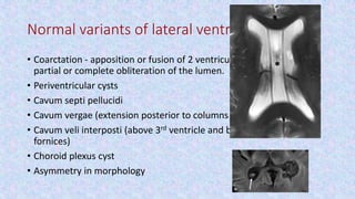 VENTRICLES AND CISTERNS OF HUMAN BRAIN.pptx