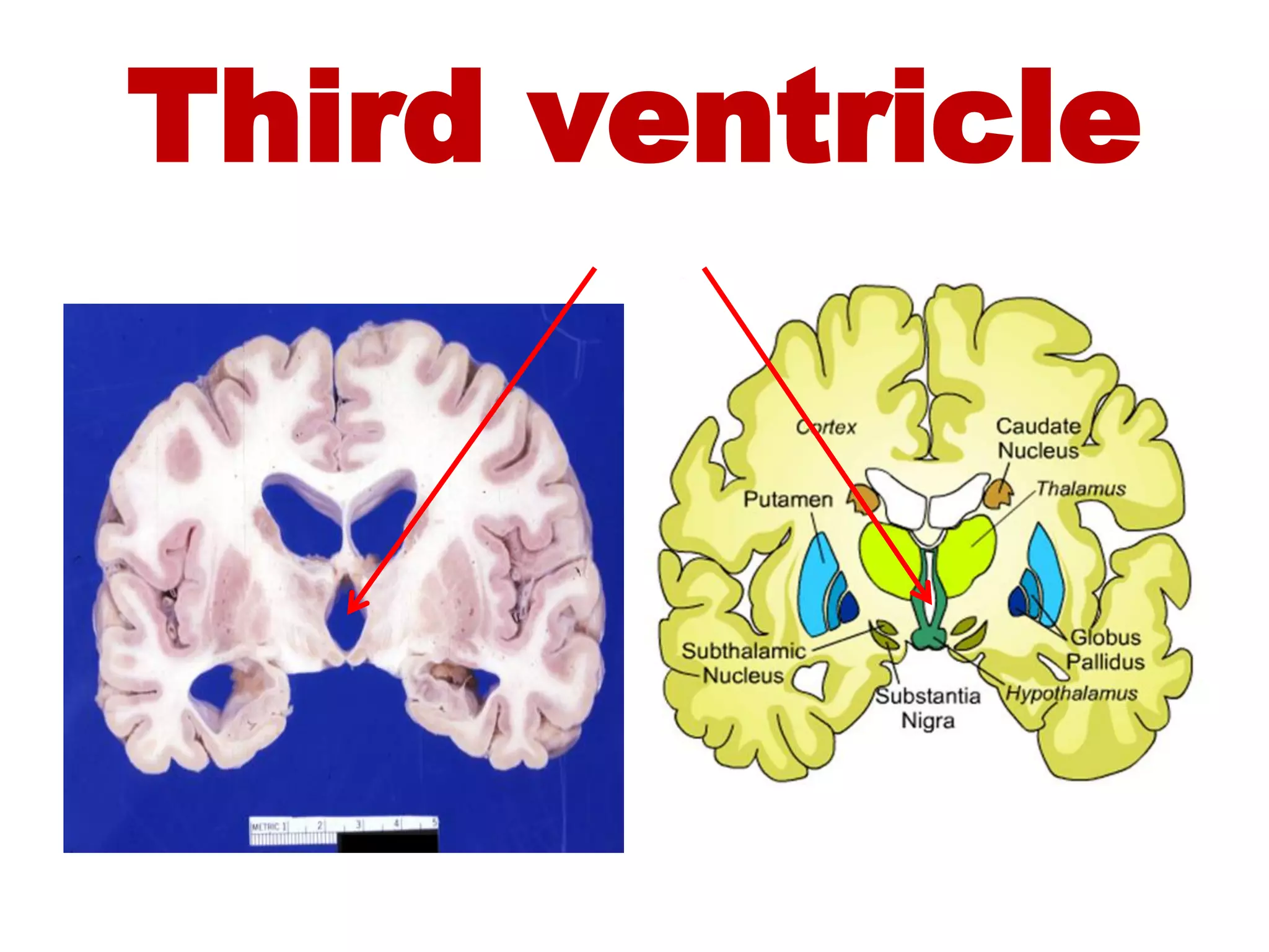Ventricles of the brain | PDF