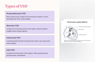 Ventricular-Septal-Defect-A-Comprehensive-Overview.pdf