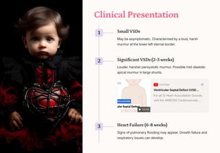 Ventricular-Septal-Defect-A-Comprehensive-Overview.pdf