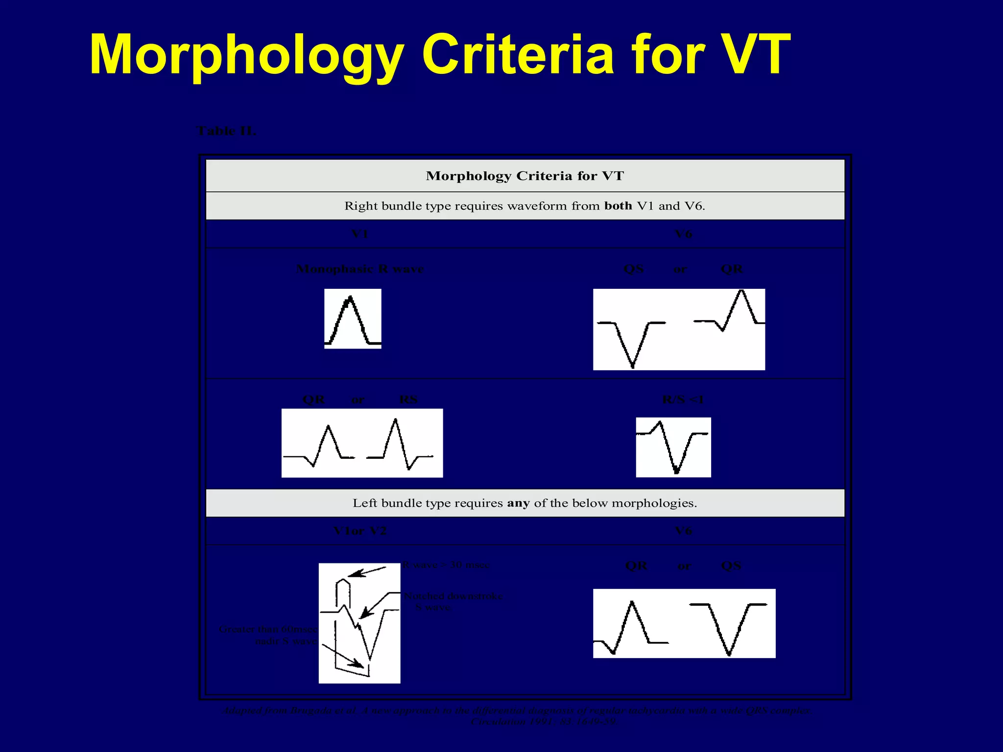 Ventricular arrhythmias | PPT