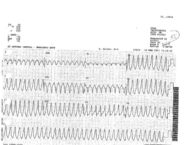 Ventricular arrhythmias | PPT | Heart and Cardiovascular Diseases ...