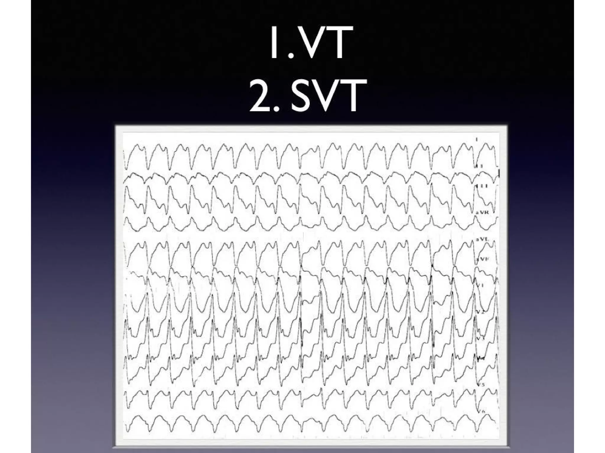 Ventricular activation | PPT