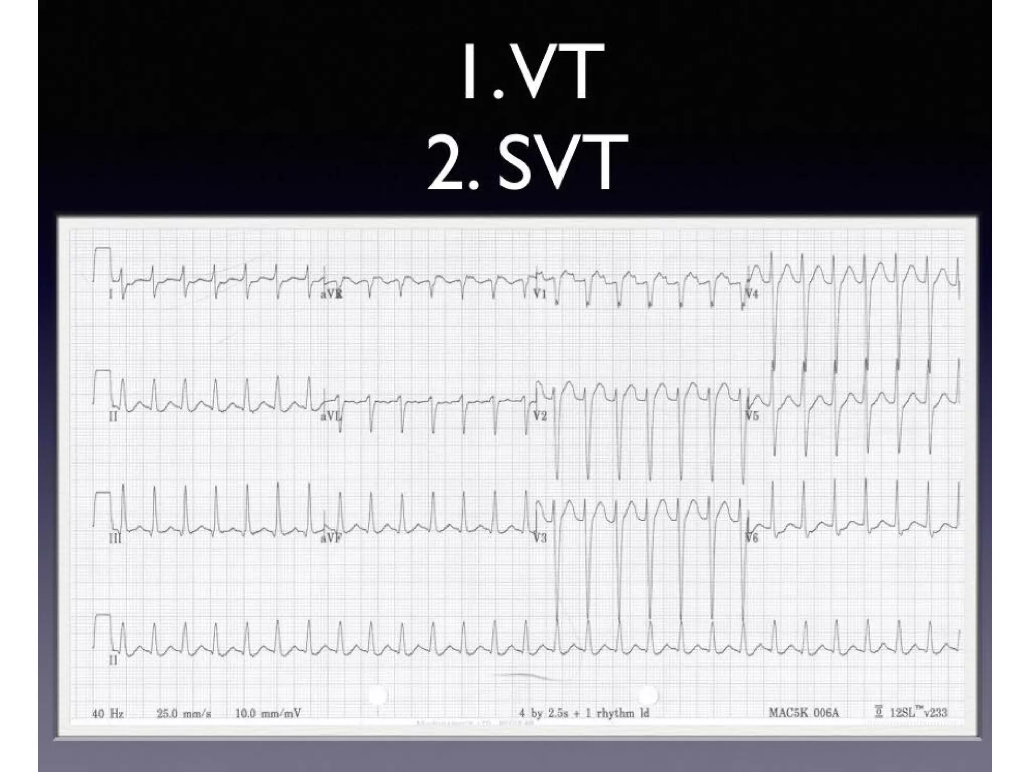 Ventricular activation | PPT