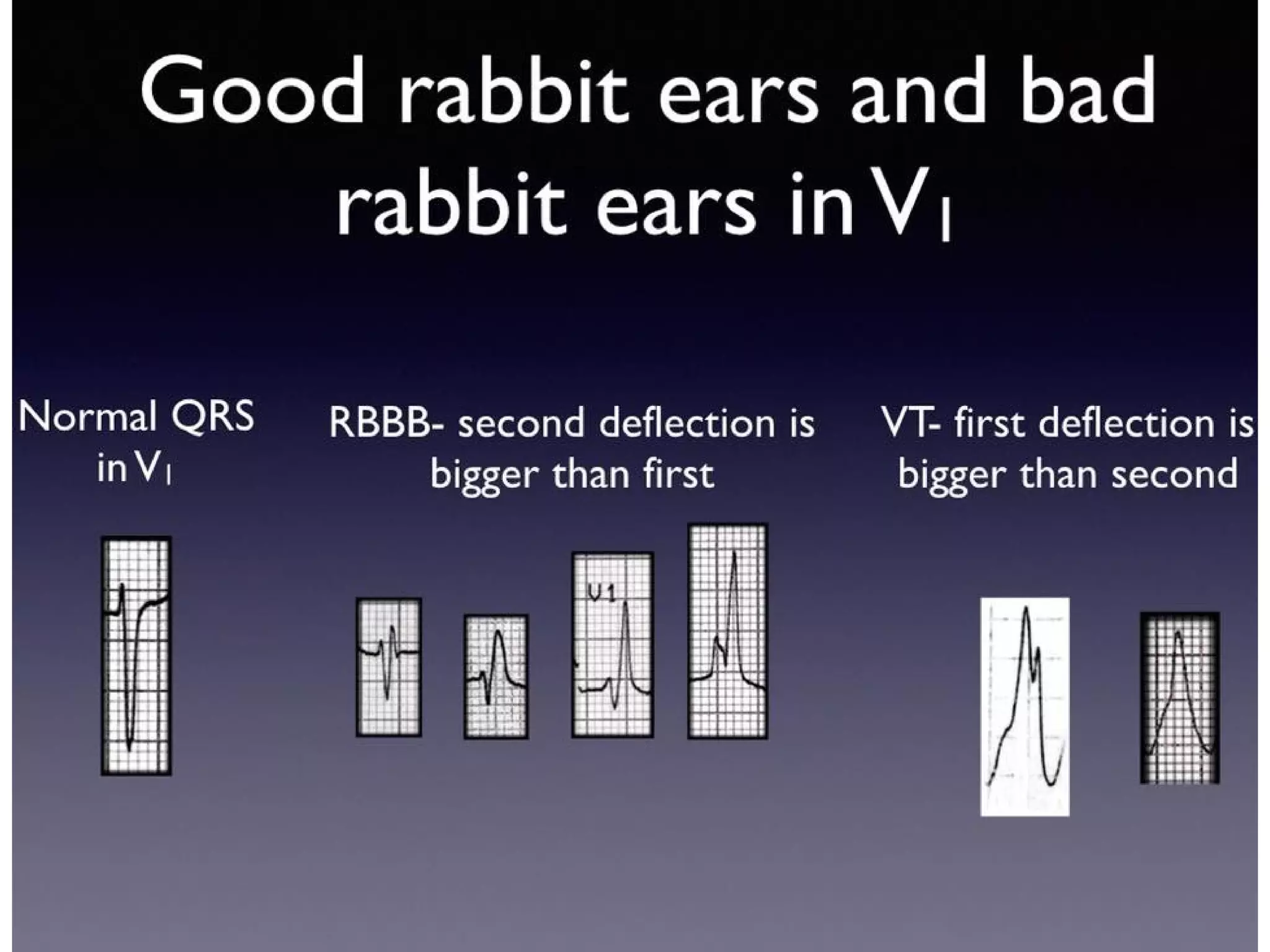 Ventricular activation | PPT