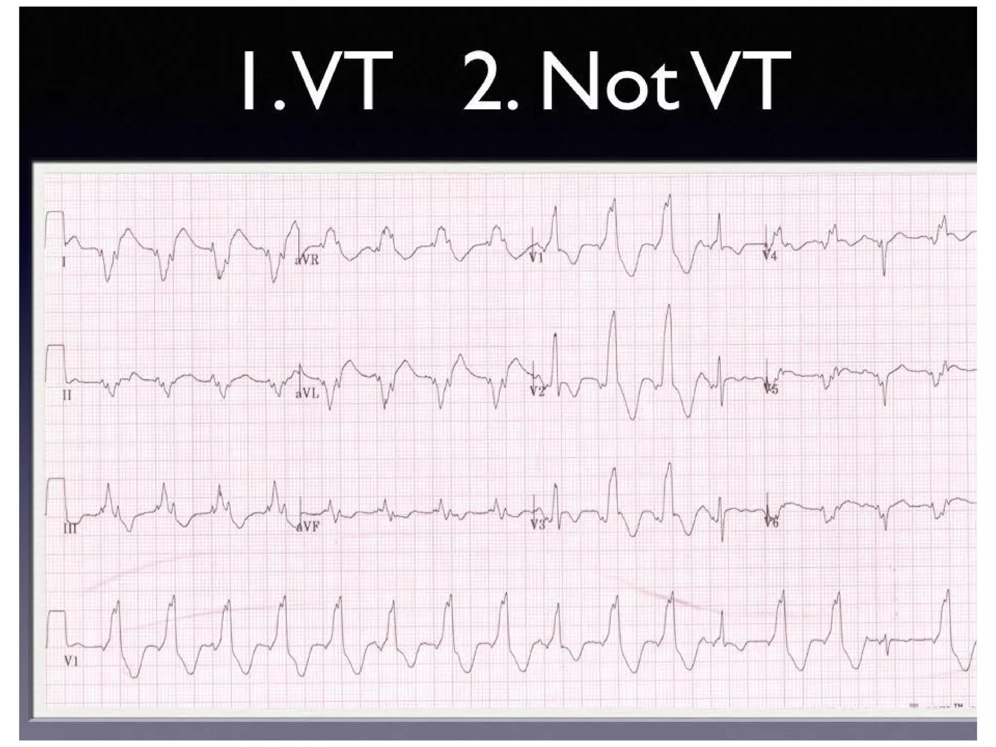 Ventricular activation | PPT