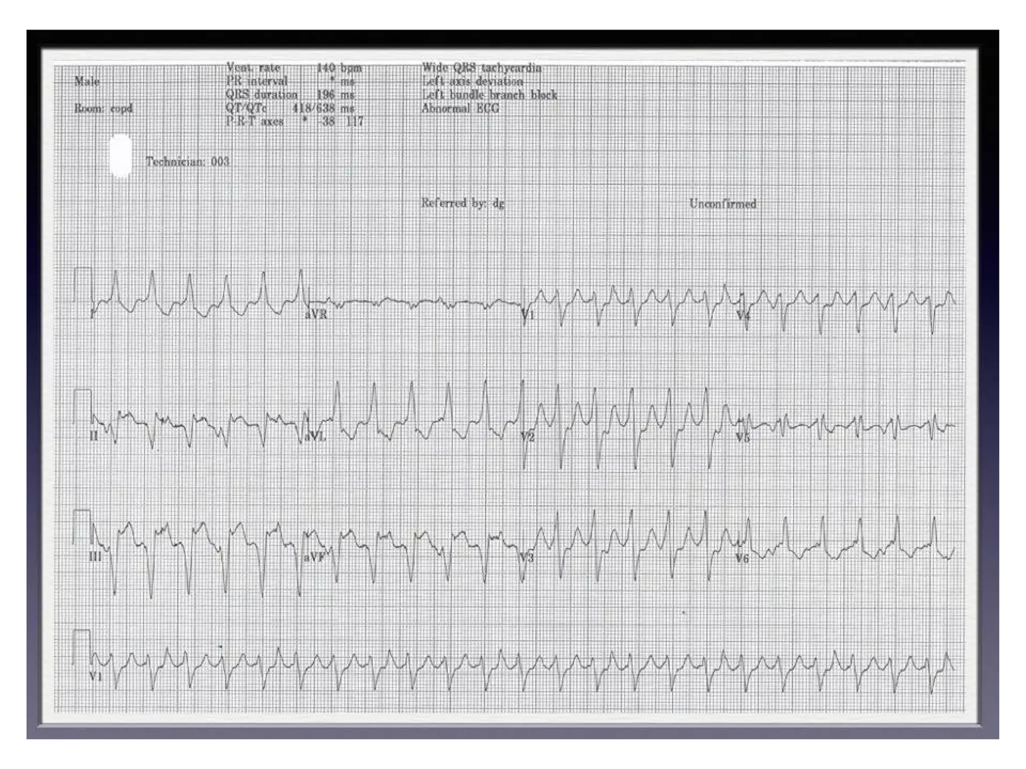 Ventricular activation | PPT