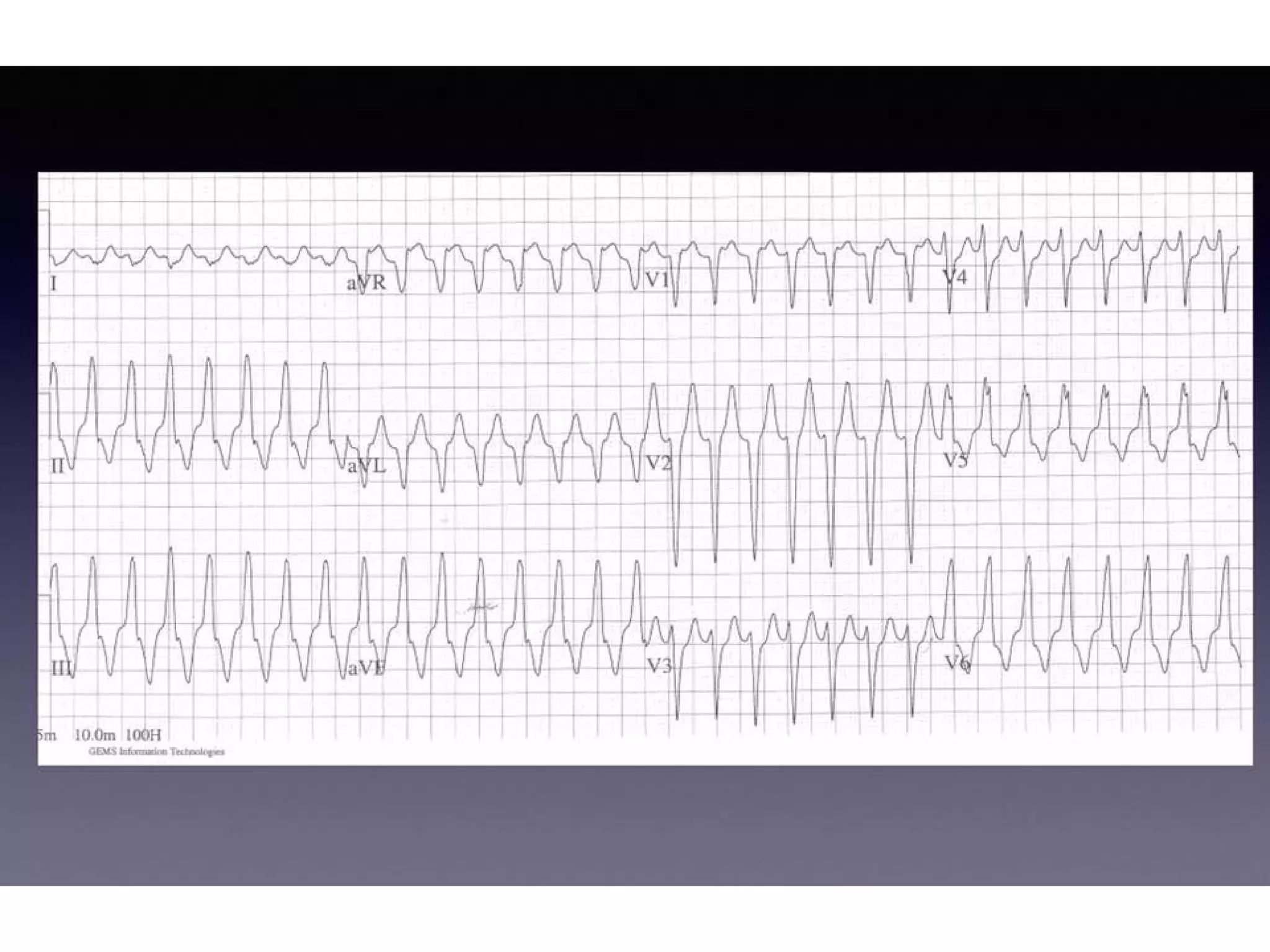 Ventricular activation | PPT