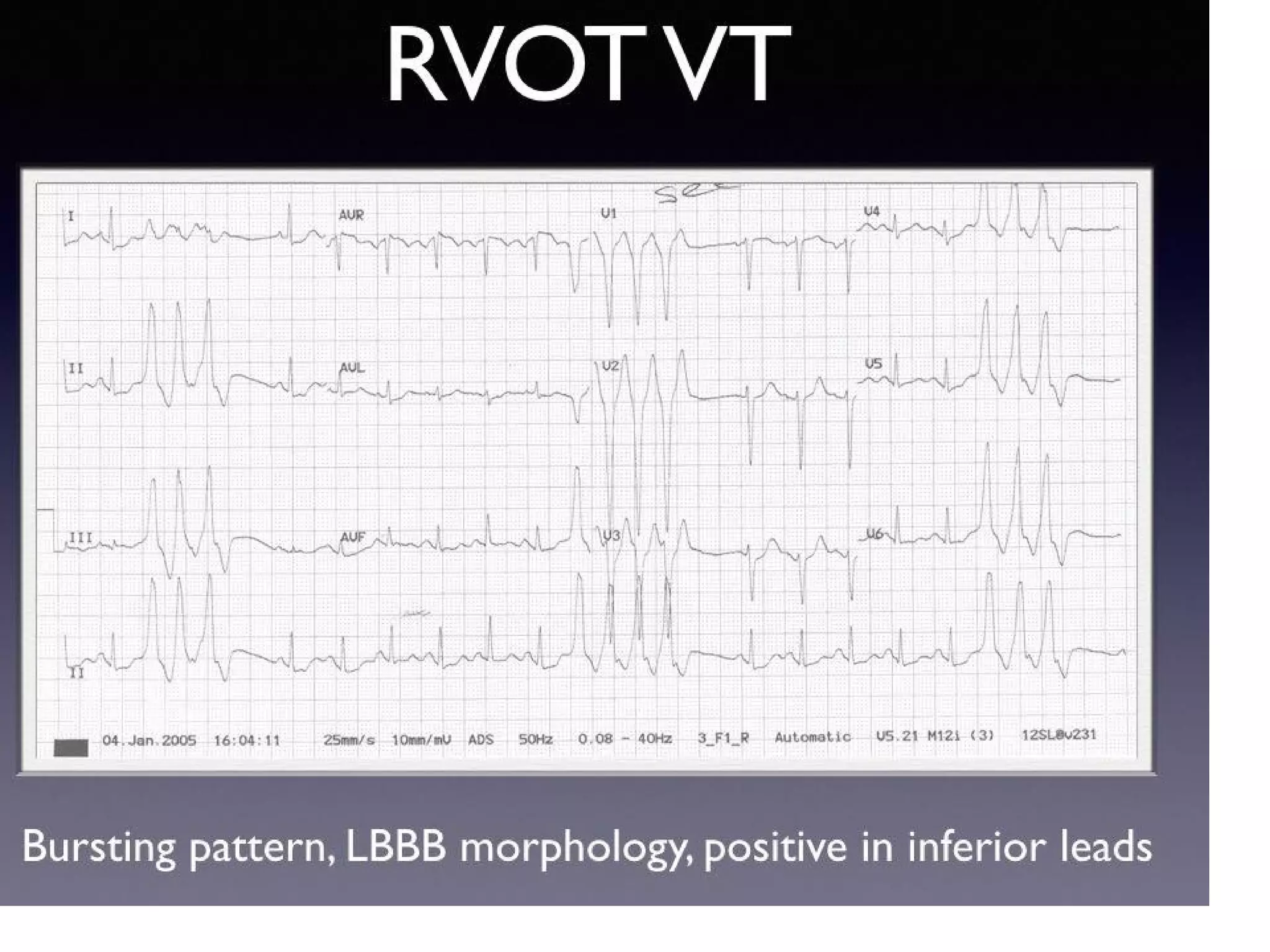 Ventricular activation | PPT