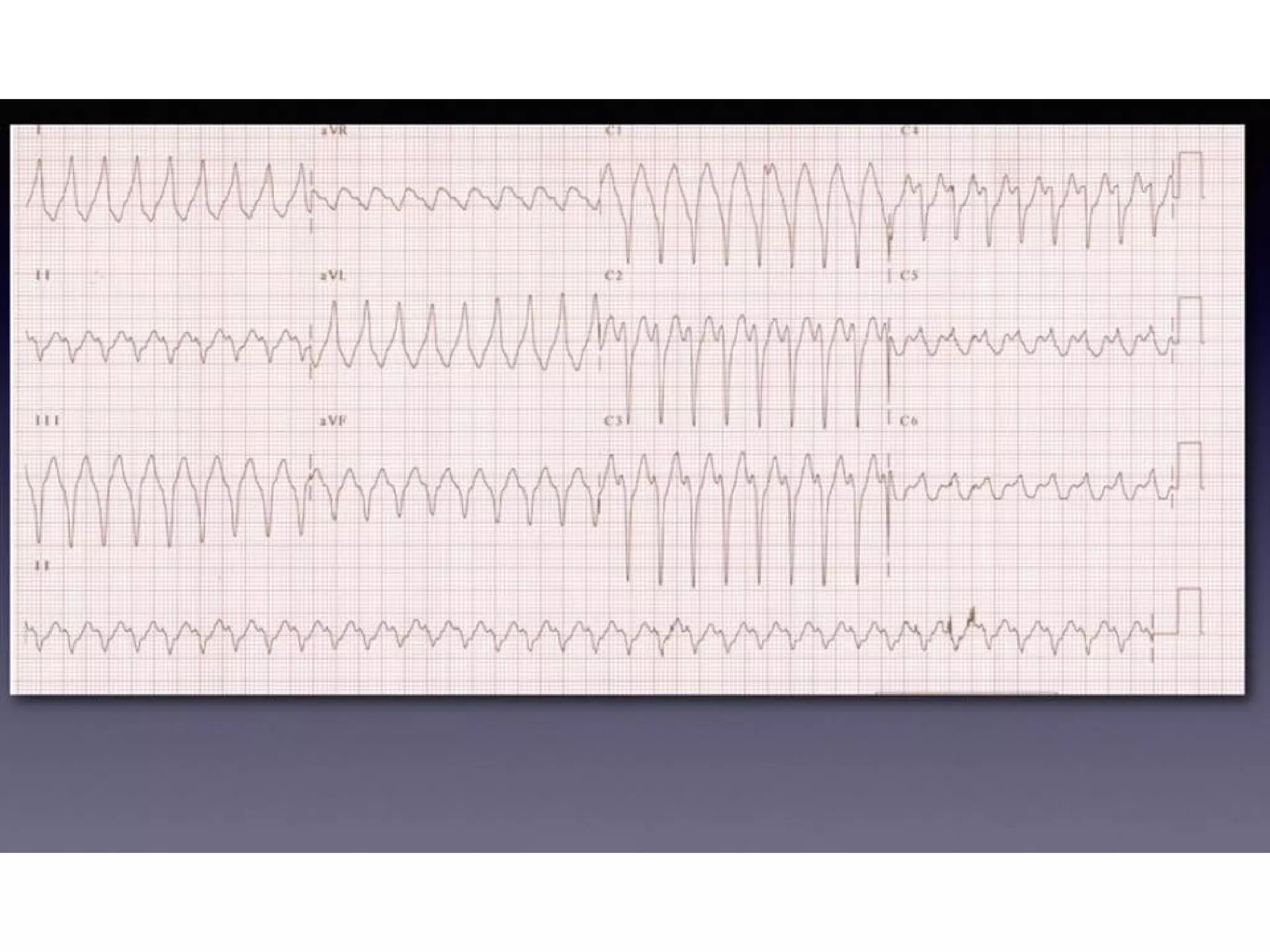 Ventricular activation | PPT