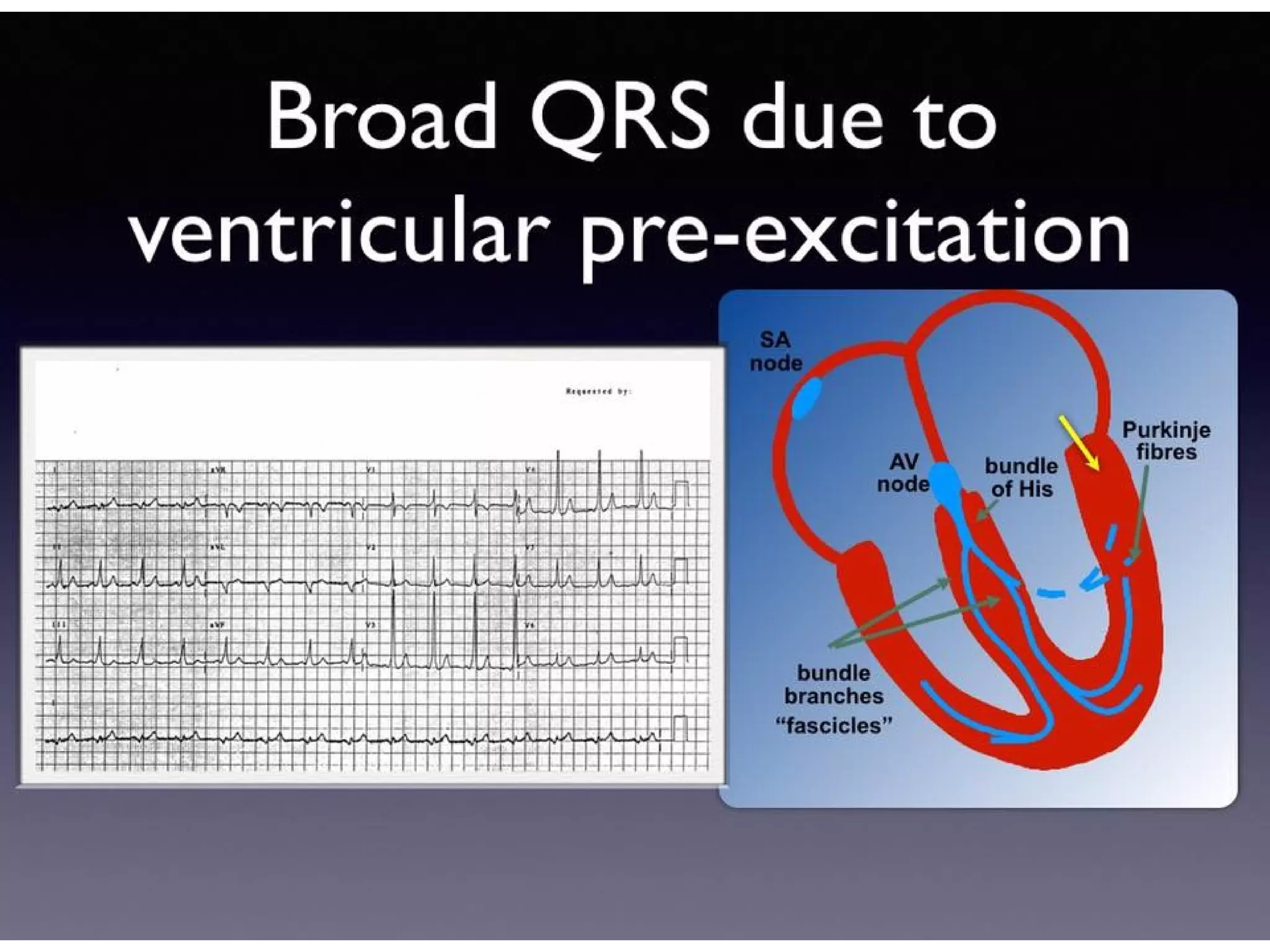 Ventricular activation | PPT