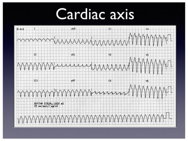 Ventricular activation | PPT