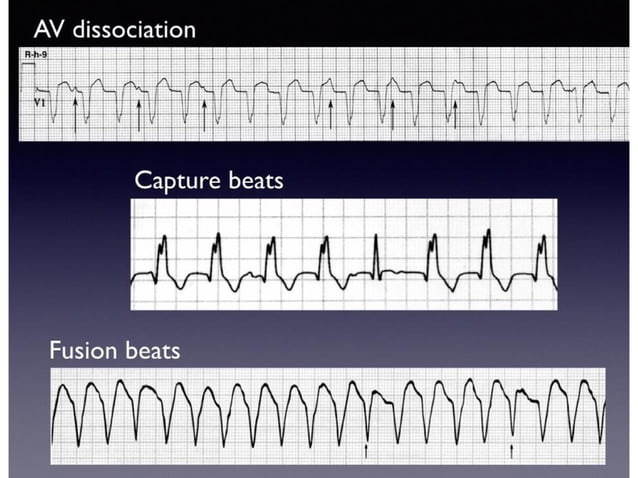 Ventricular activation | PPT