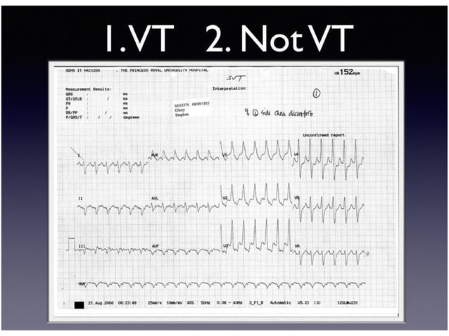 Ventricular activation | PPT