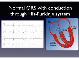 Ventricular activation | PPT