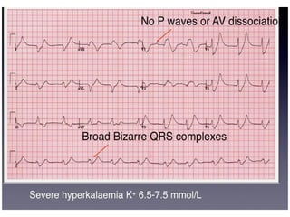 Ventricular activation | PPT