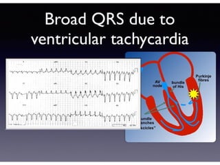 Ventricular activation | PPT