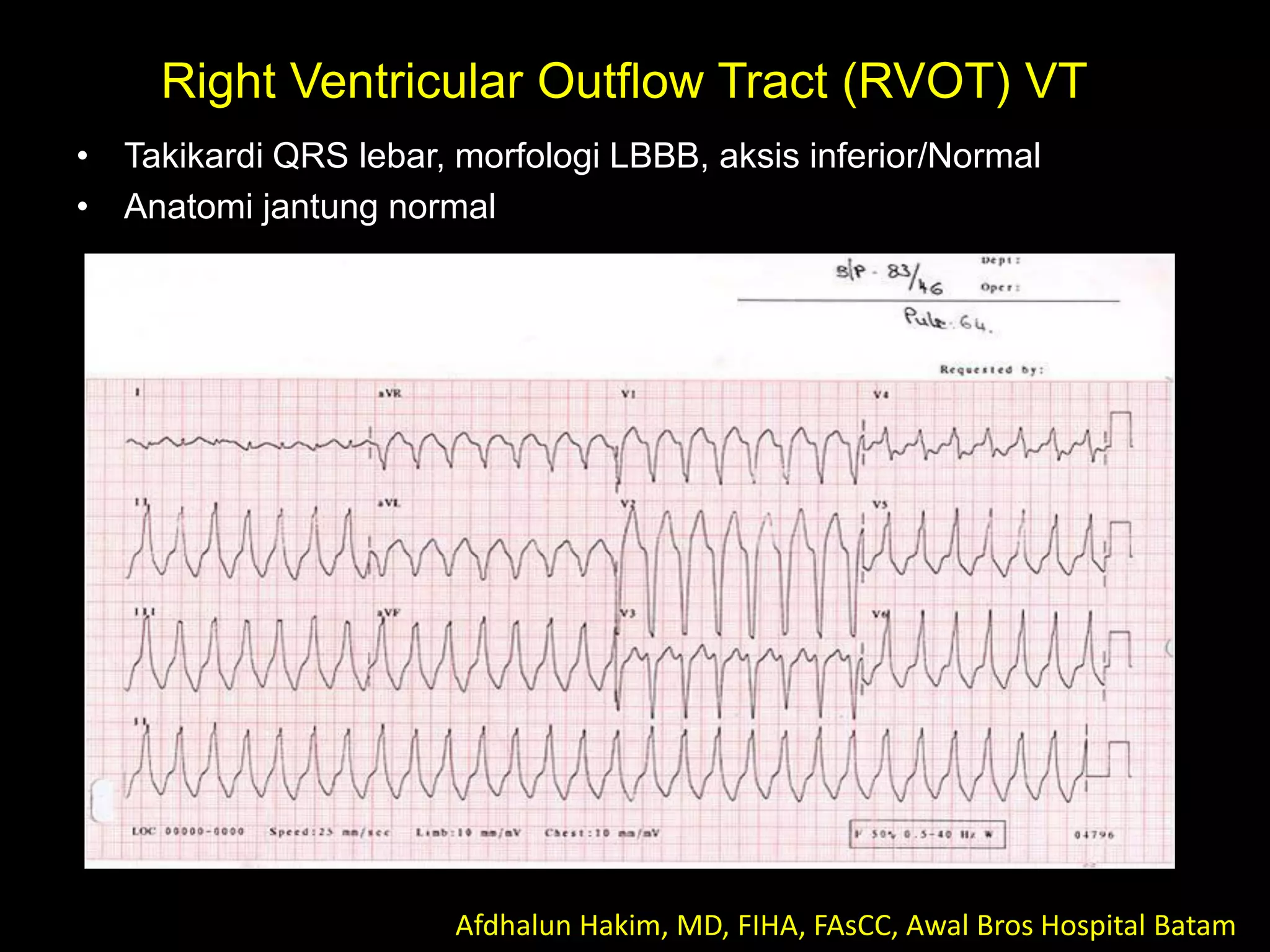 Ventricular aritmia (VT) Afdhalun Hakim, MD, FIHA, FAsCC | PDF